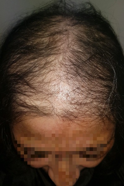 Hair replacement systems for women at Birmingham hair loss clinic